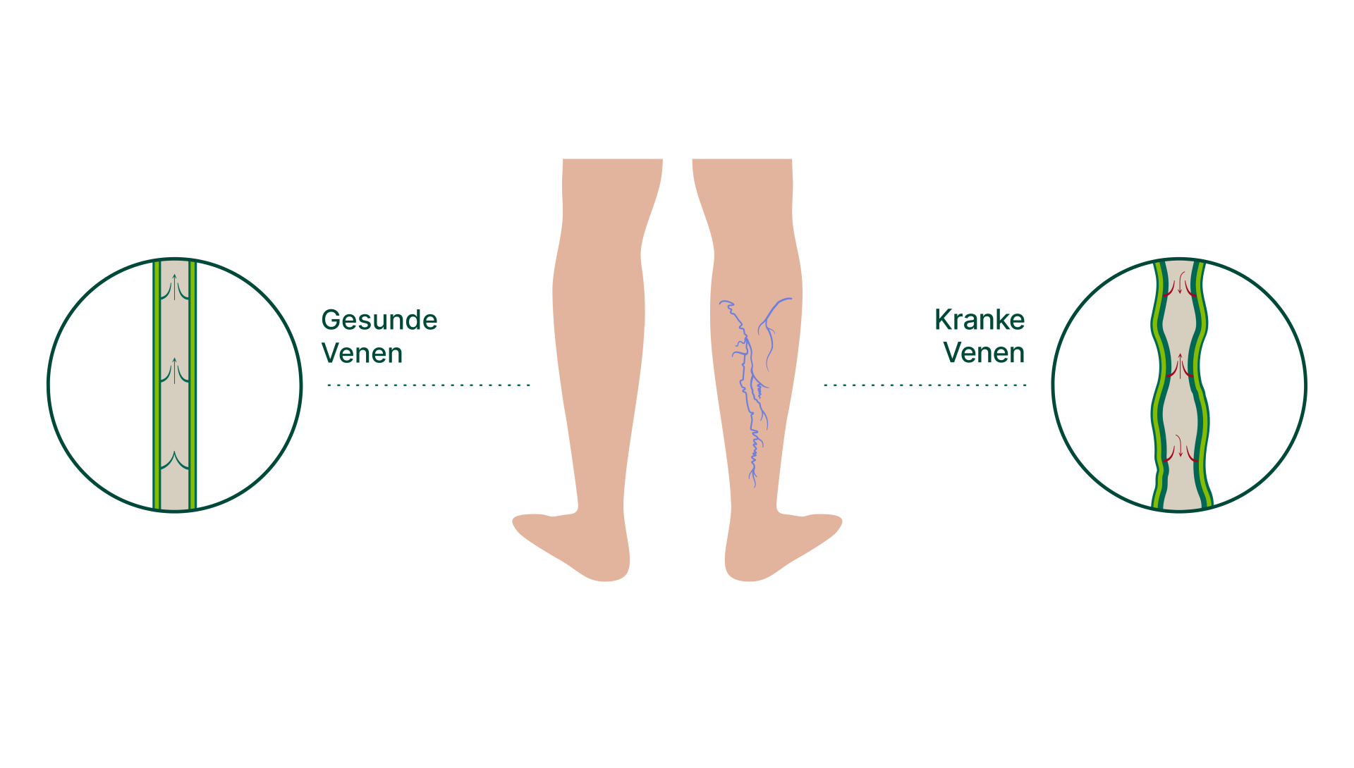 Wasser in Beinen und Füßen - Ursachen & Symptome